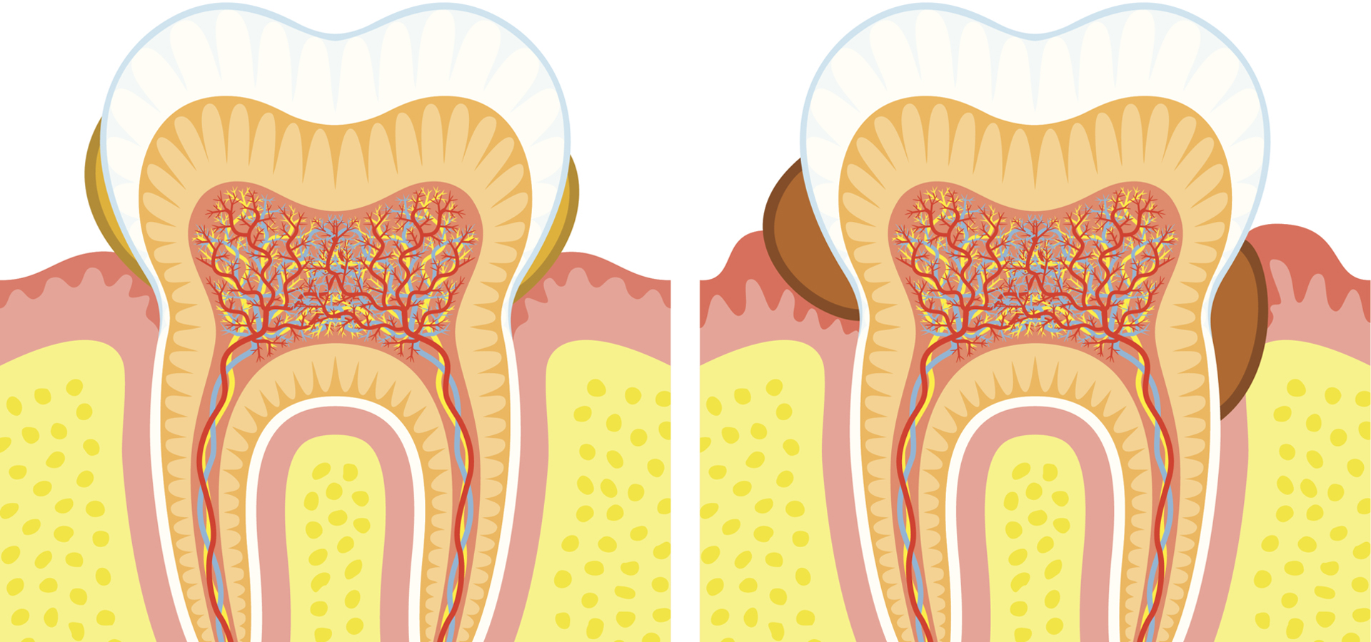Paradontoza - Tratament, Cauze si Preturi - Clinica CityDent